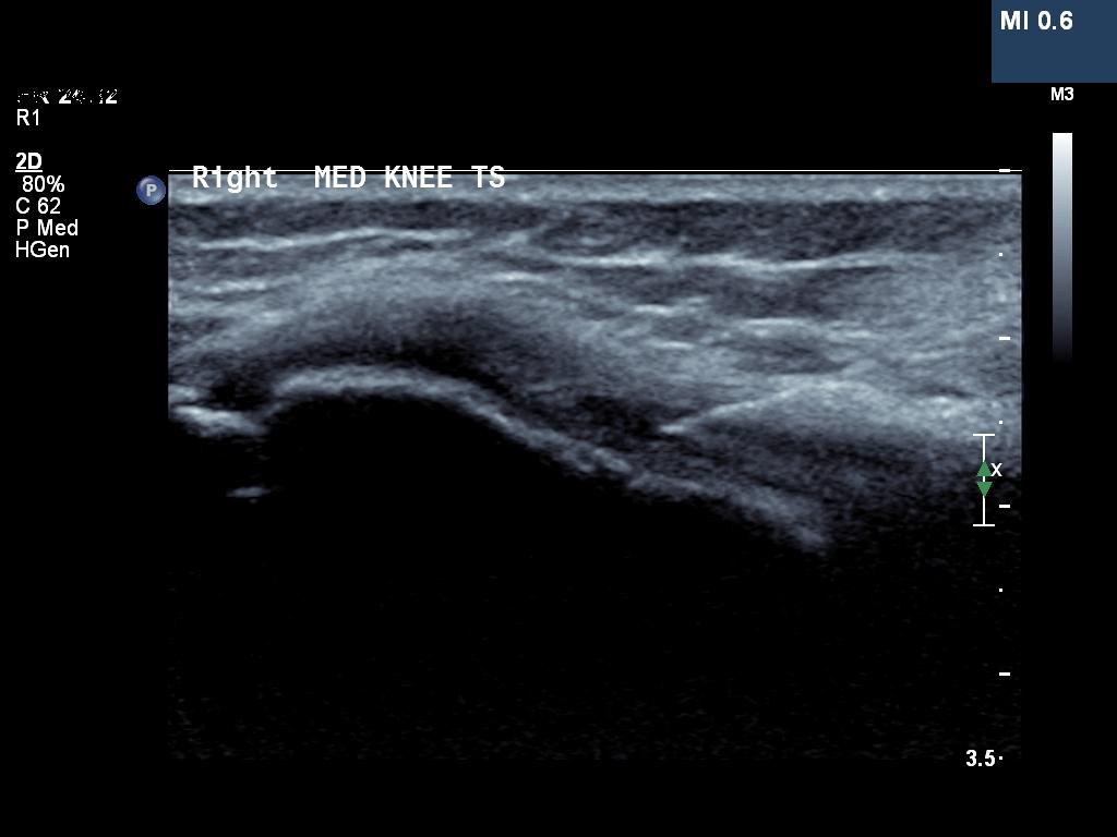 Radiology Cases: Voshell's Bursitis
