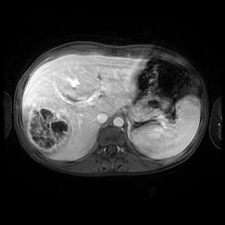 Radiology Cases: Pyogenic Liver Abscess