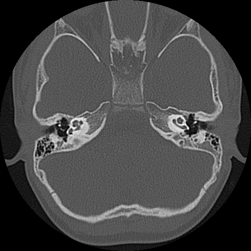 Radiology Cases: Mondini malformation