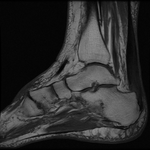 Radiology Cases: Haglund's Syndrome