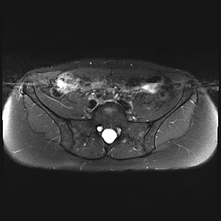 Radiology Cases: ITB Outer Lip Iliac Crest