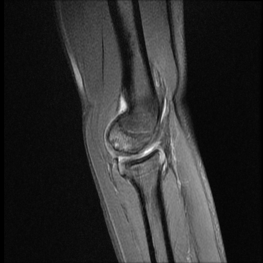 Radiology Cases: Capitellar OCD