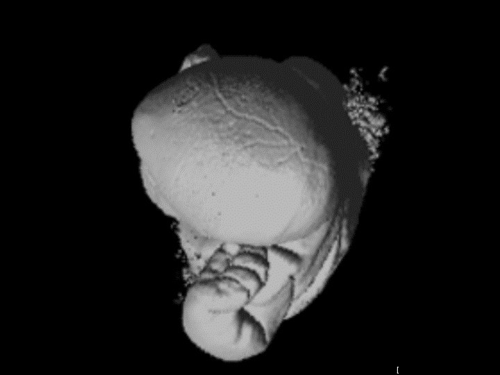 My Radiology World: "Trigonocephaly"