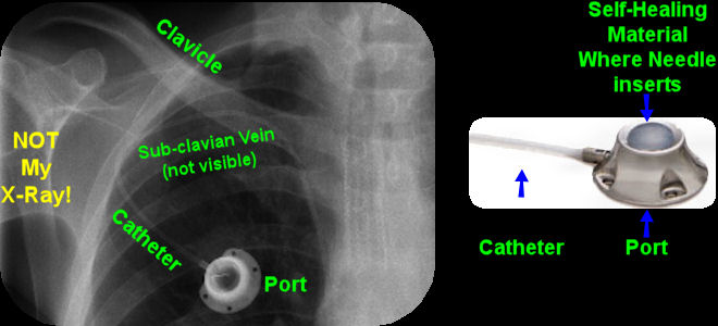 Marks Melon: 03/24/10 - Chemo Chest Port