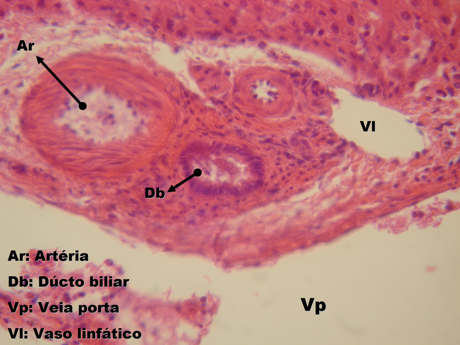 Ectasia Da Veia Porta - RETOEDU