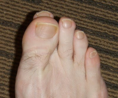 Can You Cross Your Toes?