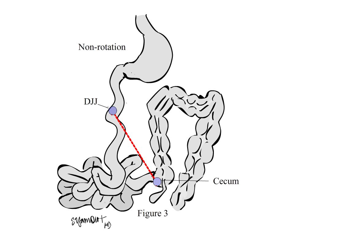 Pediatric Surgery Zone: Rotational anomalies of the midgut... what's what?