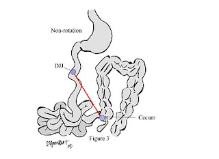 Pediatric Surgery Zone: Rotational anomalies of the midgut... what's what?