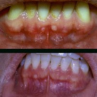 gA_Mau_oMpoNG: Gingival Fibrous Nodule