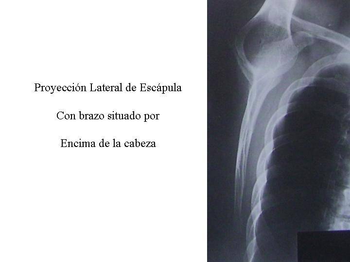 rayosx2010: Escapula lateral