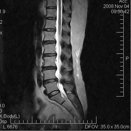 KUMPUL RADIOGRAFER: Teknik CT Scan dan MRI Untuk Kasus HNP