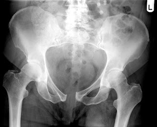 International University: Open book fracture