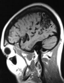 Lynne's CT & MRI Pathology Blogs: Arteriovenous Malformation (AVM)