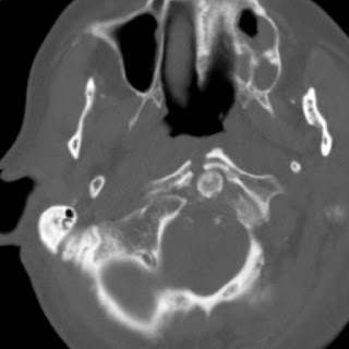 Lynne's CT & MRI Pathology Blogs: Jefferson's Fracture