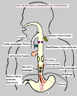 (Solved) - ESOPHAGUS : Congenital Anomalies - Atresia and ...