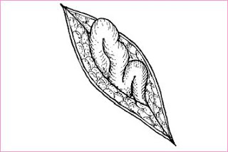 Nurse Base: RECOGNIZING DEHISCENCE AND EVISCERATION