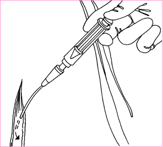 Nurse Base: IRRIGATING A DEEP WOUND