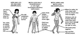 Portafolios: DISCAPACIDAD MOTORA