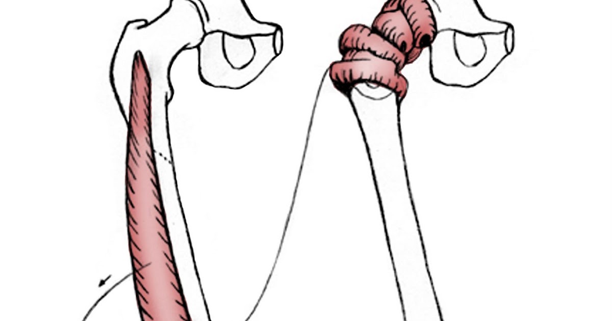 Gandhi Medical College: Girdlestone Arthroplasty