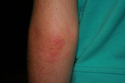 Madeline's JDM Story: Updated pics of Madeline's JDM rash