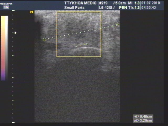 BÀI SOẠN VỀ SIÊU ÂM CHẨN ĐOÁN: HÌNH ẢNH SIÊU ÂM của GOUT/ULTRASOUND ...