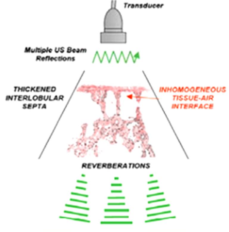 BÀI SOẠN VỀ SIÊU ÂM CHẨN ĐOÁN: A-LINES, B-LINES and AIR ARTIFACTS