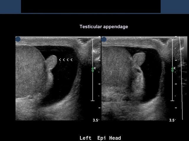 cochinblogs: 3-D ultrasound image of appendix of testis: