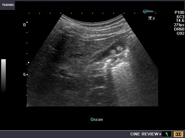 Tips On Health: Sludge balls in the Gall bladder: