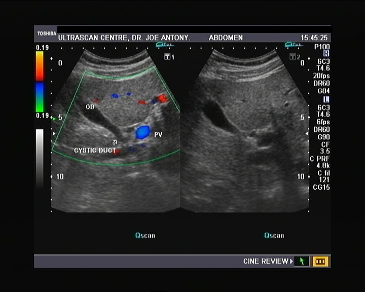 Ultrasound and Color Doppler videos: Cystic duct- ultrasound video:
