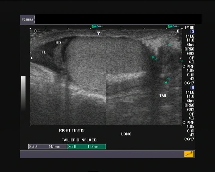 Ultrasound and Color Doppler videos: Focal epididymitis: