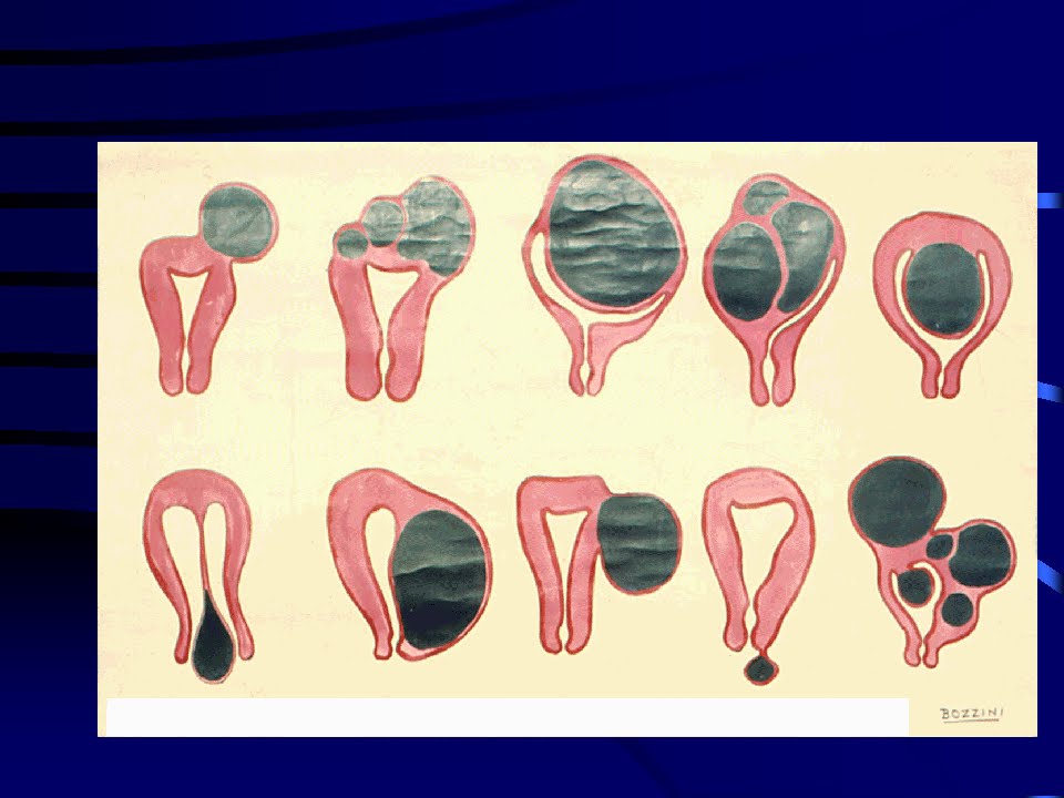 GinecoUSP: Mioma Uterino