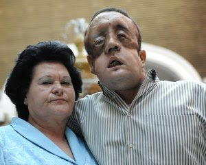 LA KOZA NOZTRA: Reaparece después de transplante de cara