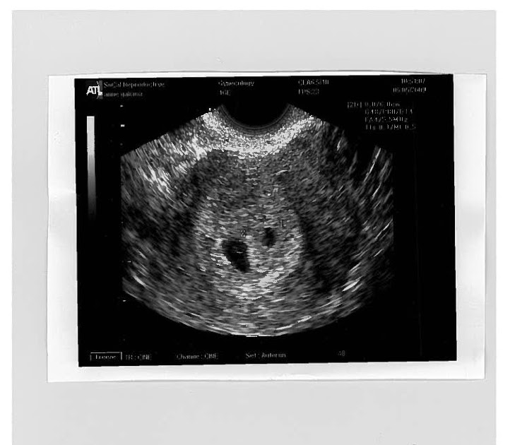 My In Vitro Journey: Update