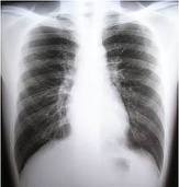 ASUHAN KEPERAWATAN TUBERCULOSIS (TBC) PARU