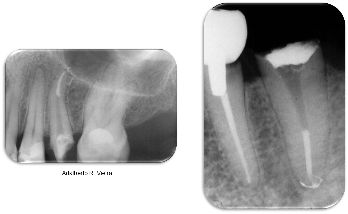 Odontologia: Retentores Intra-radiculares