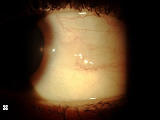 Pingueculitis a.k.a. "Inflamed Pinguecula"