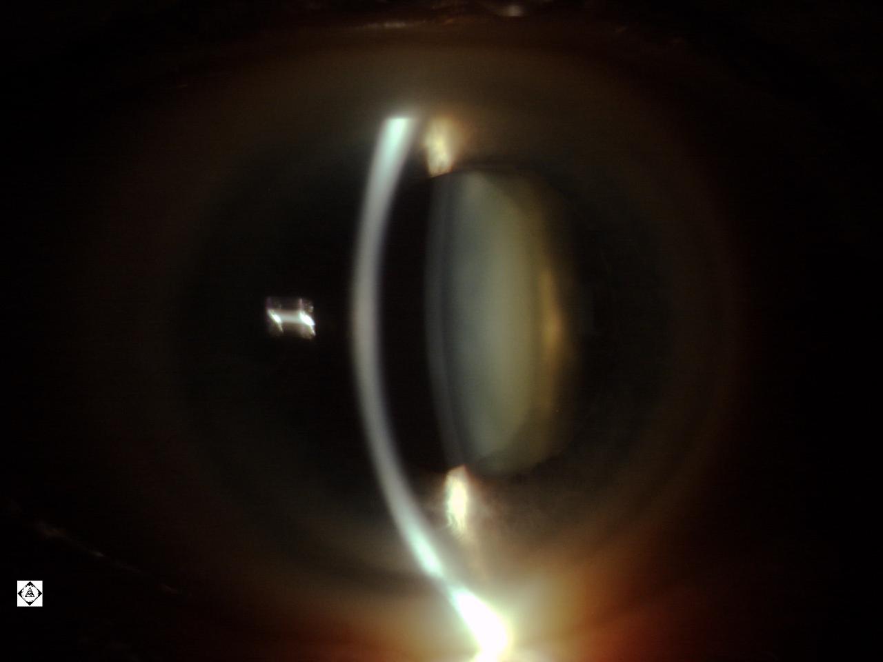 Sonoran Desert Eye Center: Cataract