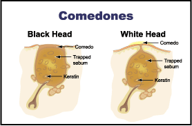 Acne Care And Treatment: What Causes Acne