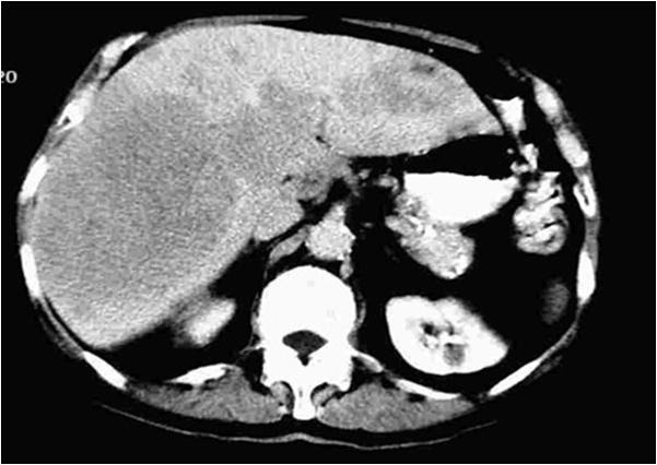 CARCINOMA HEPATOCELULAR: CARCINOMA HEPATOCELULAR