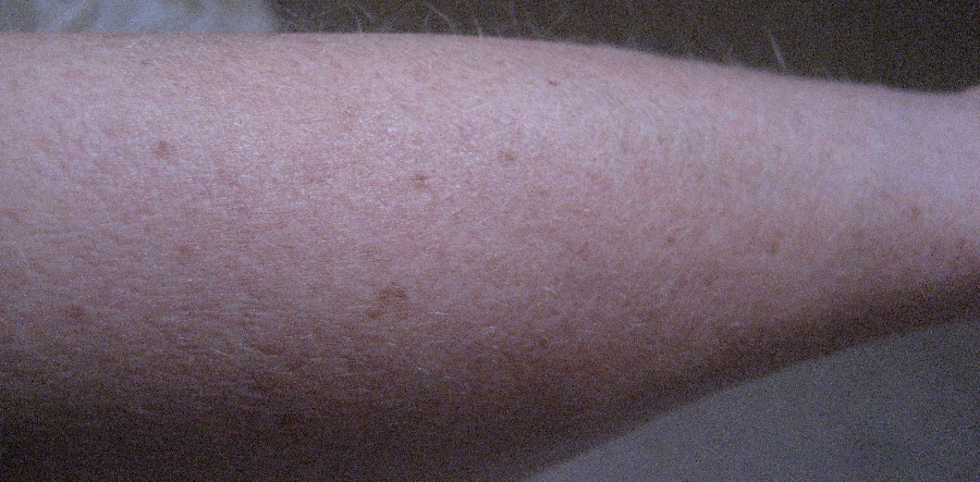 Chemical Peels For Acne And Anti Aging Tca Peel Arms Day 10