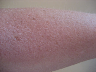 Chemical Peels for Acne and Anti Aging: TCA 50% Chemical peel - before ...