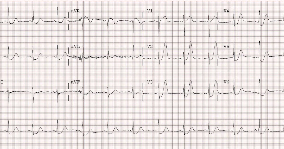 Dr. Smith's ECG Blog: Hyperacute T waves