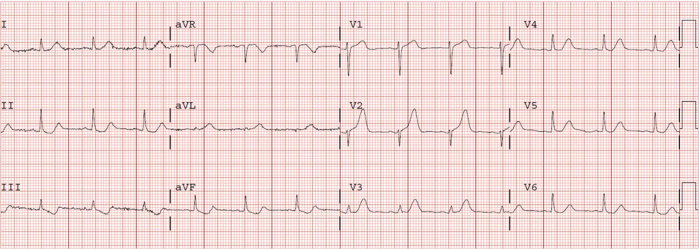 Notes from Dr. RW: STEMI, NSTEMI or STEMI equivalent?