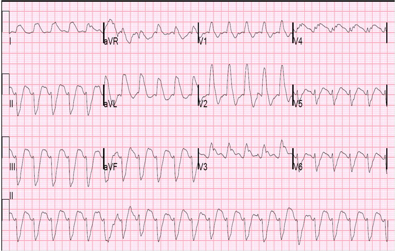 Dr. Smith's ECG Blog: Wide Complex Tachycardia; It's really sinus, RBBB ...