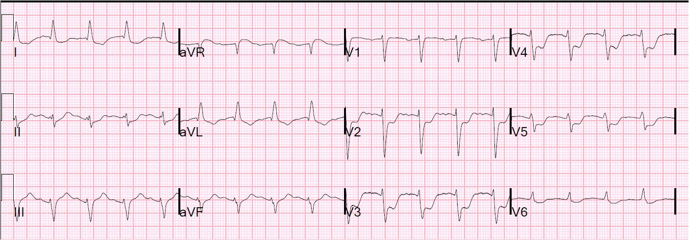 Dr. Smith's ECG Blog: Incomplete LBBB, posterior STEMI, posterior leads ...