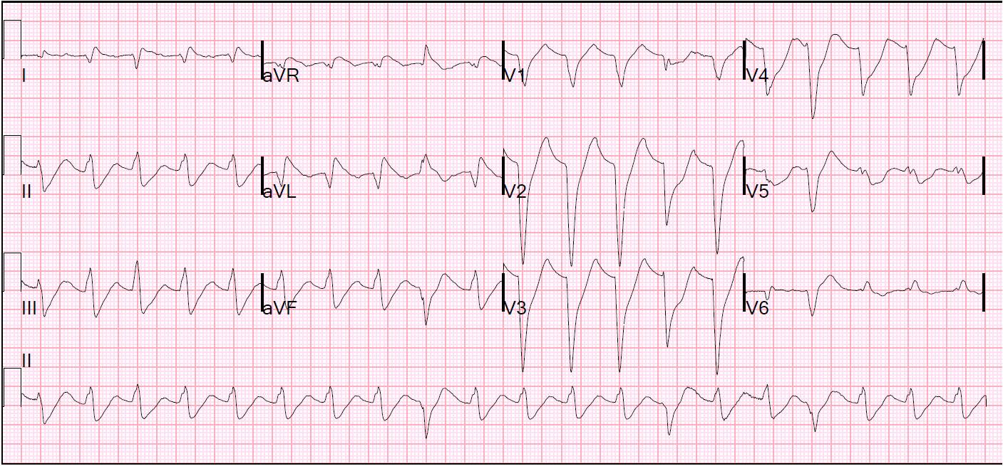 Dr. Smith's ECG Blog: Cardiac Arrest, Wide Complex, Is it STEMI?