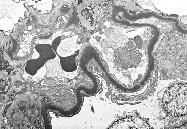 Nephron Power: IN THE NEWS- DENSE DEPOSIT DISEASE AND MGUS?