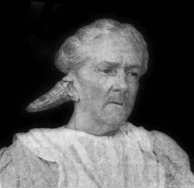 Extreme [ Humans + Creativities + Secrets ]: Cutaneous Horn or Cornu ...