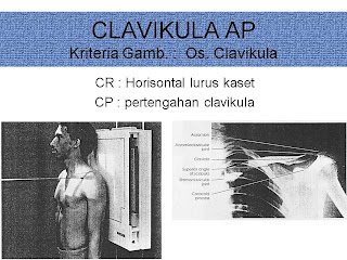 TEKNIK RADIOGRAFI CLAVICULA ~ Catatan Radiograf