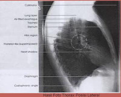 TEKNIK RADIOGRAFI THORAX - Radiografer